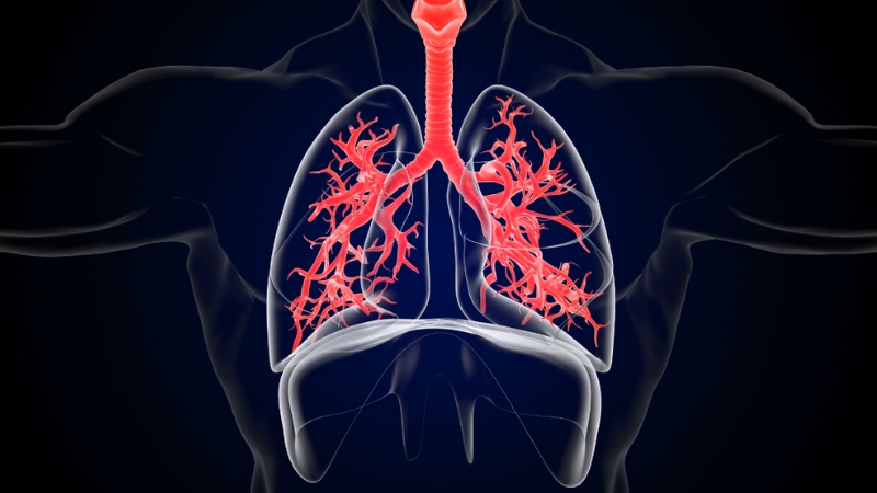 The Four Stages of COPD Explained - A Detailed Overview