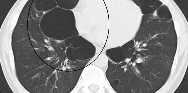 Pulmonary Function Tests Archives - Namdrc